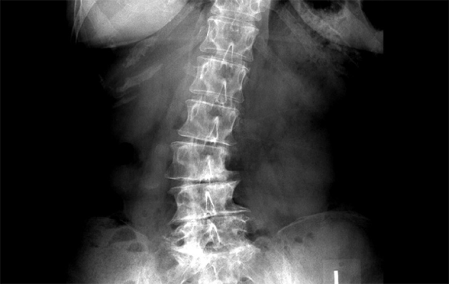 Como é o processo de diagnóstico da escoliose? – Escoliose Brasil