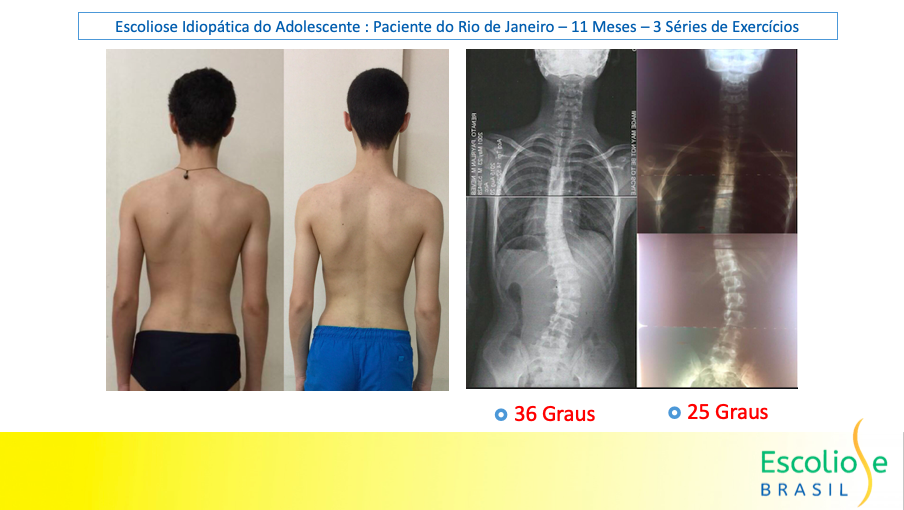 Casos Clínicos – Escoliose Brasil 5 – Escoliose Brasil