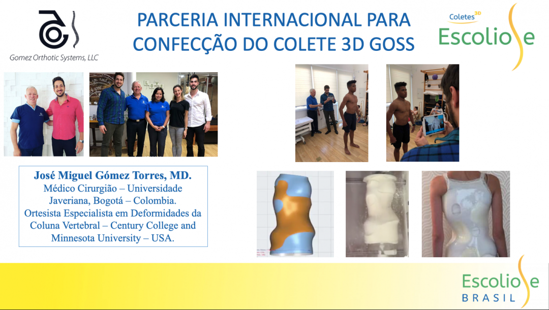 Coletes Ortopédicos 3D para Escoliose 2 – Escoliose Brasil
