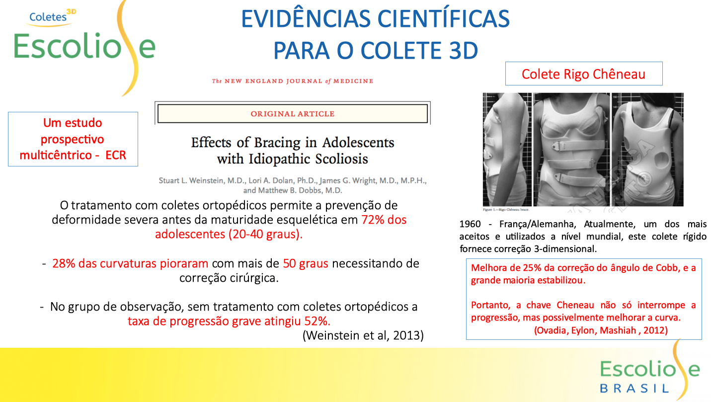 Colete para Escoliose – Colete 3D Escoliose Brasil 2 – Escoliose Brasil