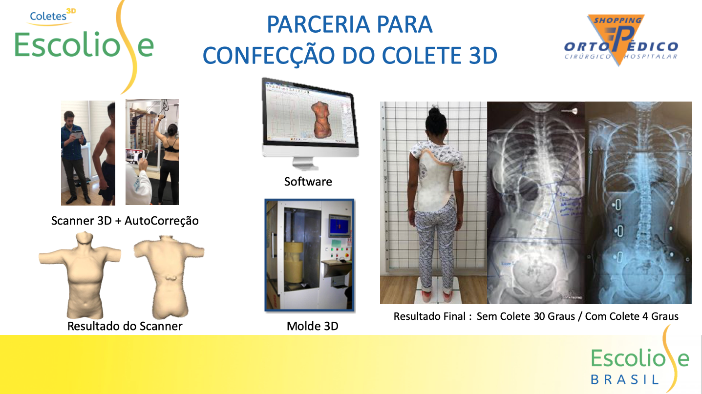 Colete para Escoliose – Colete 3D Escoliose Brasil – Escoliose Brasil
