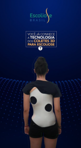 colete ortopedico 3d para tratamento escoliose – Escoliose Brasil