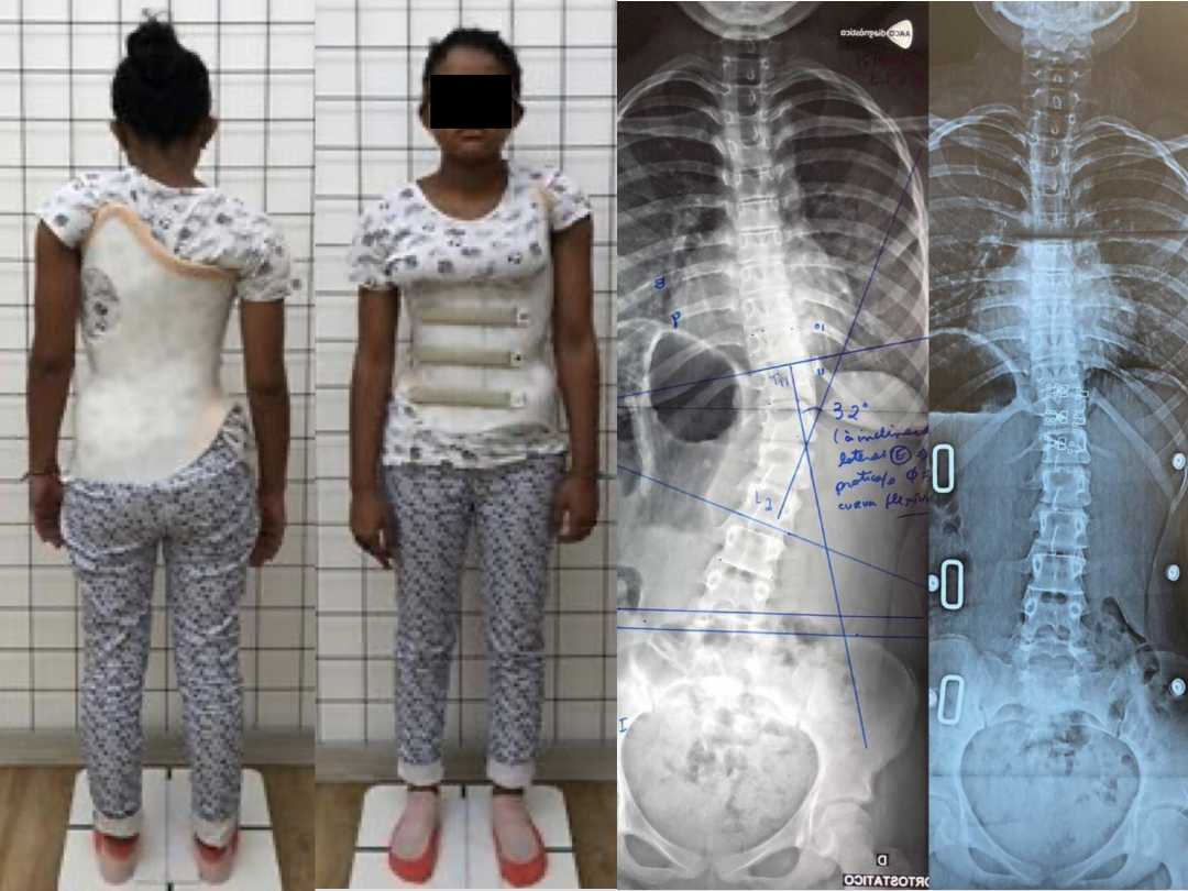 Coletes Ortopédicos S4D para Escoliose / Hipercifose – Escoliose Brasil